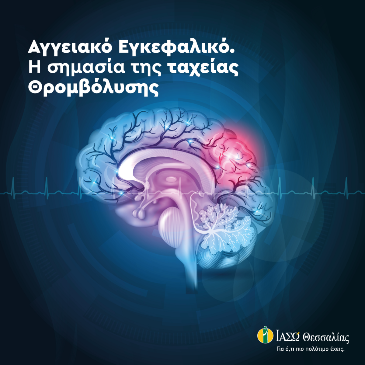 ΙΑΣΩ Θεσσαλίας: Αγγειακό Εγκεφαλικό Επεισόδιο- Η σημασία της ταχείας ...